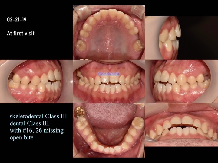 Treatment Of Skeletal Class III Dental Class III Treatment Of Skeletal Class III Dental Class III