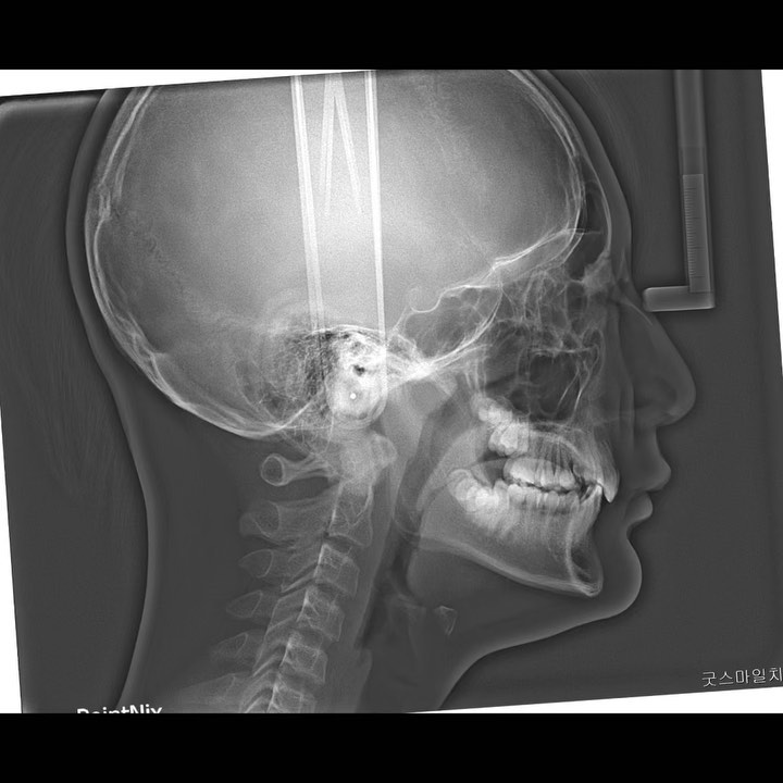 Treatment Of Skeletal Class II Dental Class II Di 